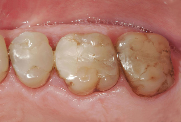 Inlays - Onlays | Centre dentaire Champel | Ginebra