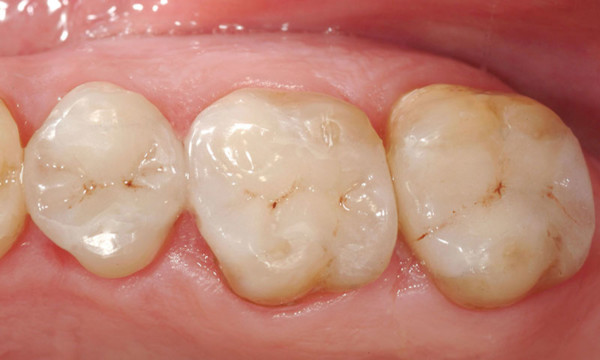 Inlays - Onlays | Centre dentaire Champel | Ginebra